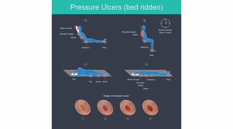 Top 7 Reasons Pressure Ulcer Rates are Still Going Up in Hospitals ...